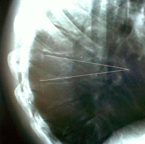 Scheuermann's Kyphosis - Spine - Orthobullets